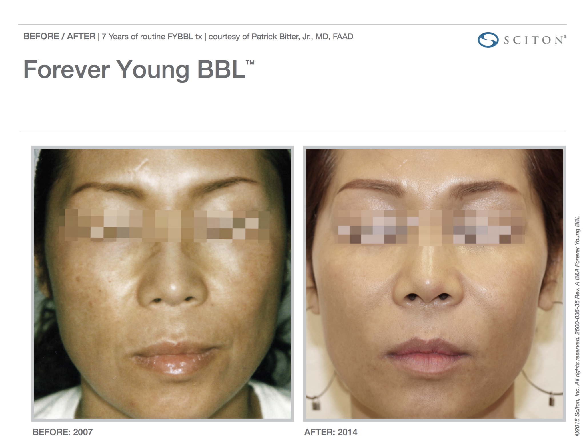 BBL Treatments in Midtown Atlanta and Alpharetta Georgia