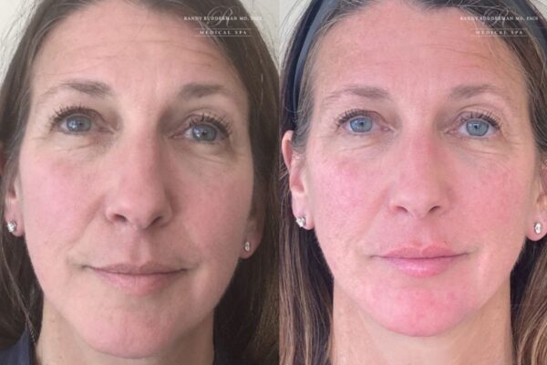 Injectable and Filler Before and After Photos in Atlanta and Alpharetta
