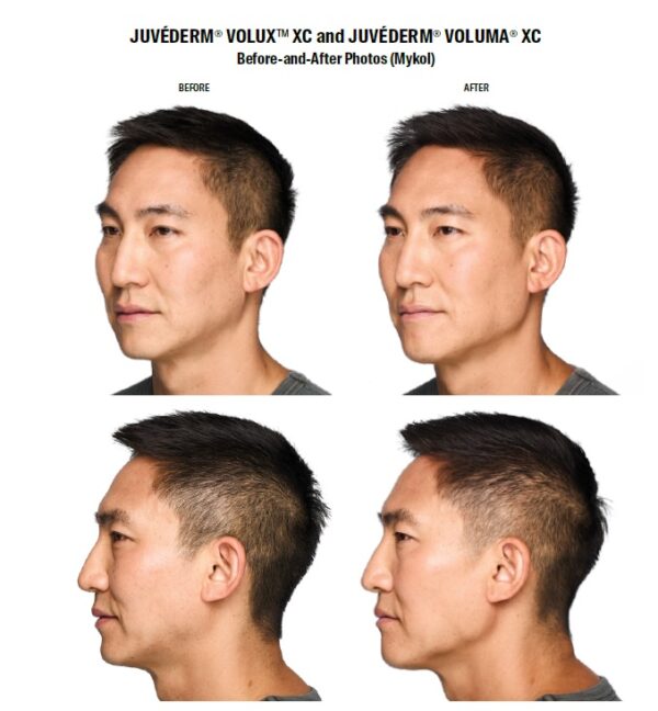 Juvederm® Volux® XC | Jawline Filler in Atlanta and Alpharetta